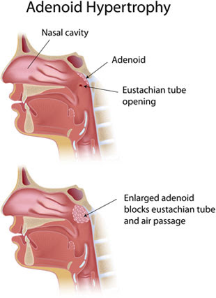 Adenoidectomy surgery - The Right Nose