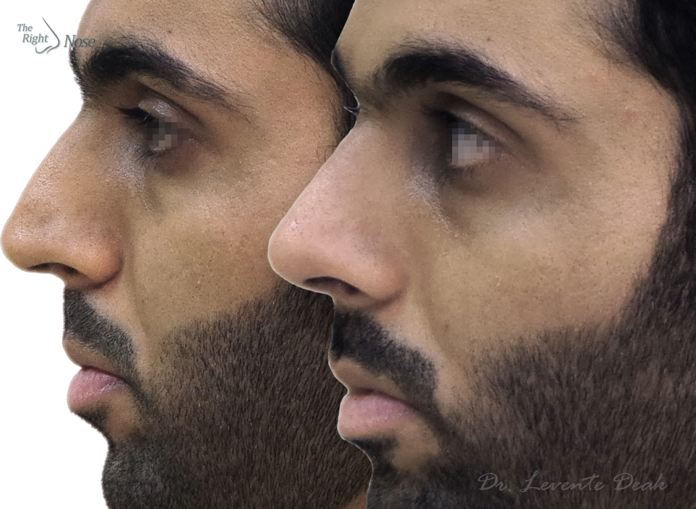 Male Tip - The Right Nose