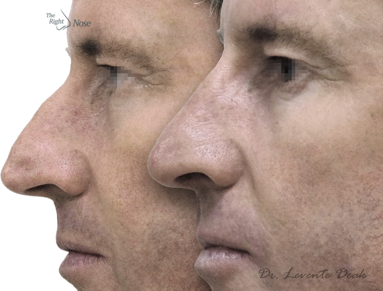 Dorsal Line - The right nose