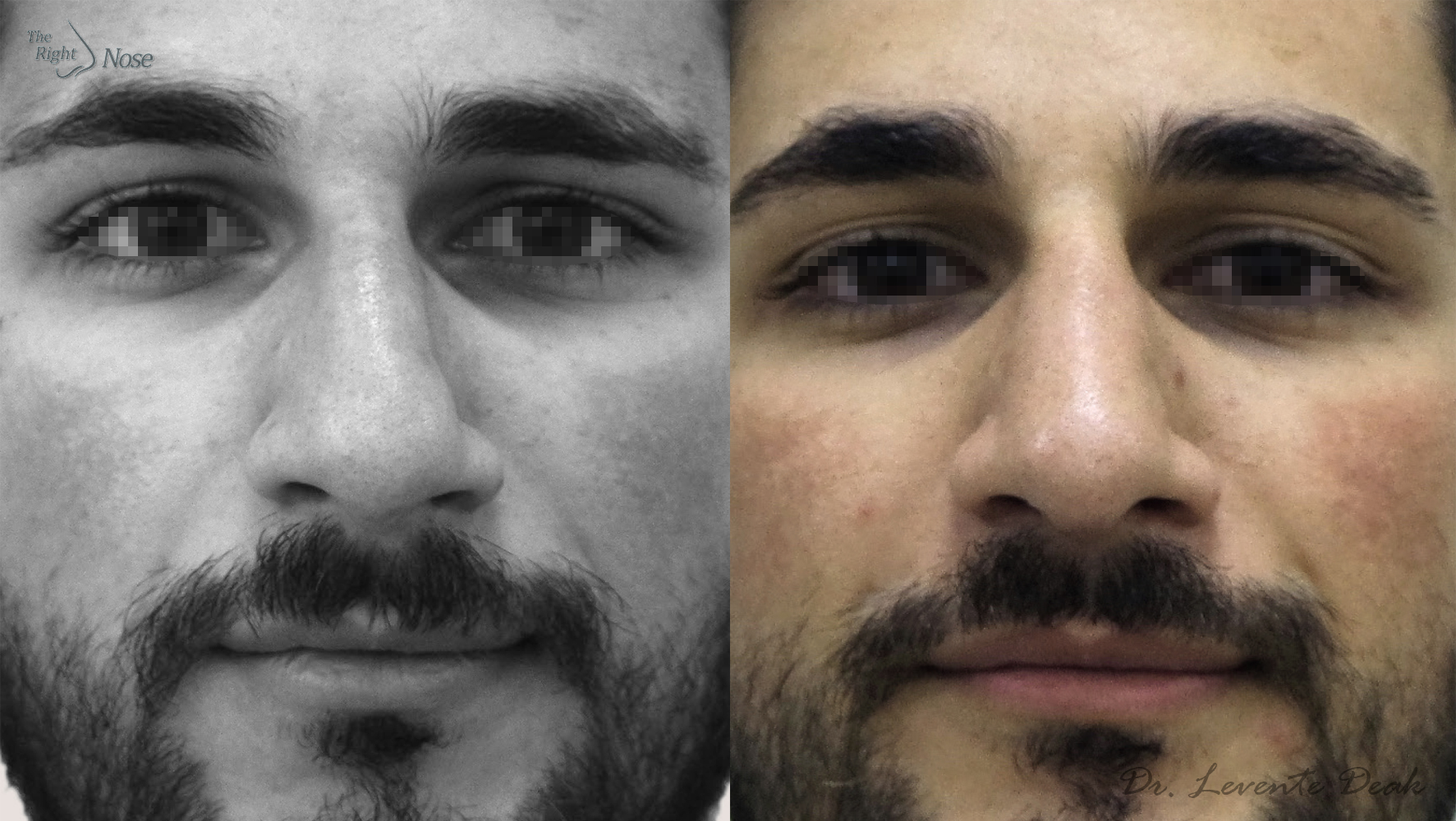 Dorsal Line - The right nose