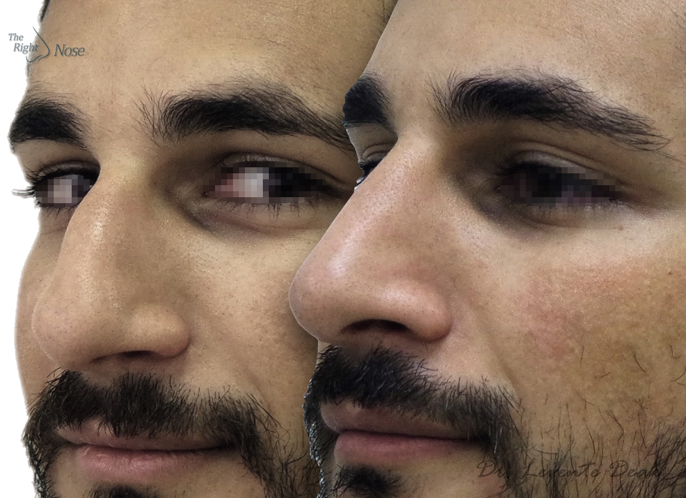 Dorsal Line - The right nose