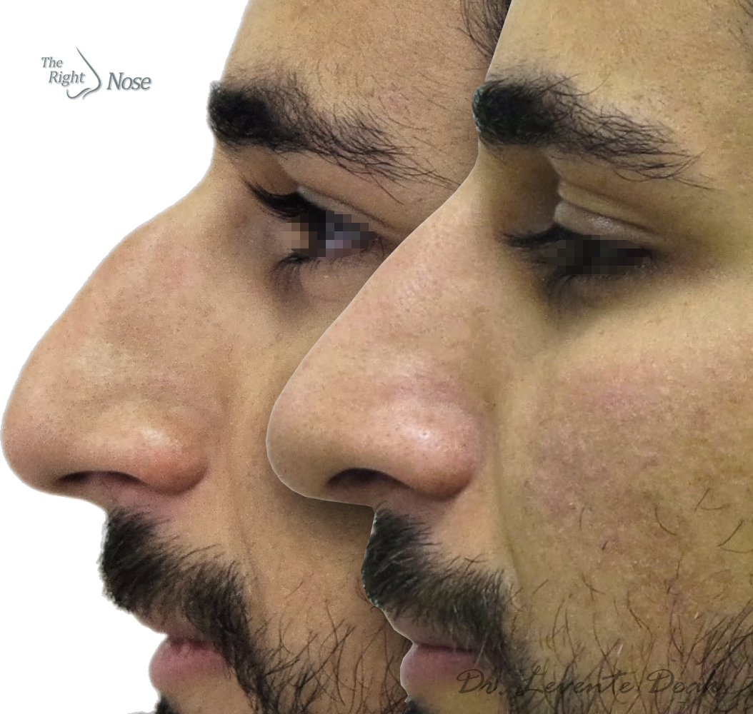 Dorsal Line - The right nose