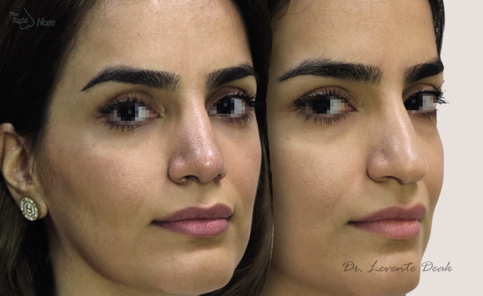 Female - Tip correction - The right nose