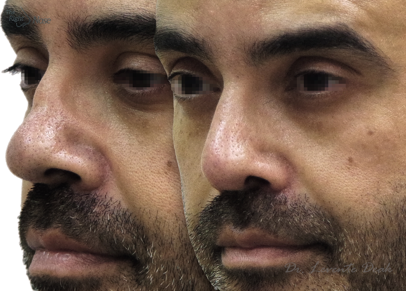 Dorsal Line - The right nose