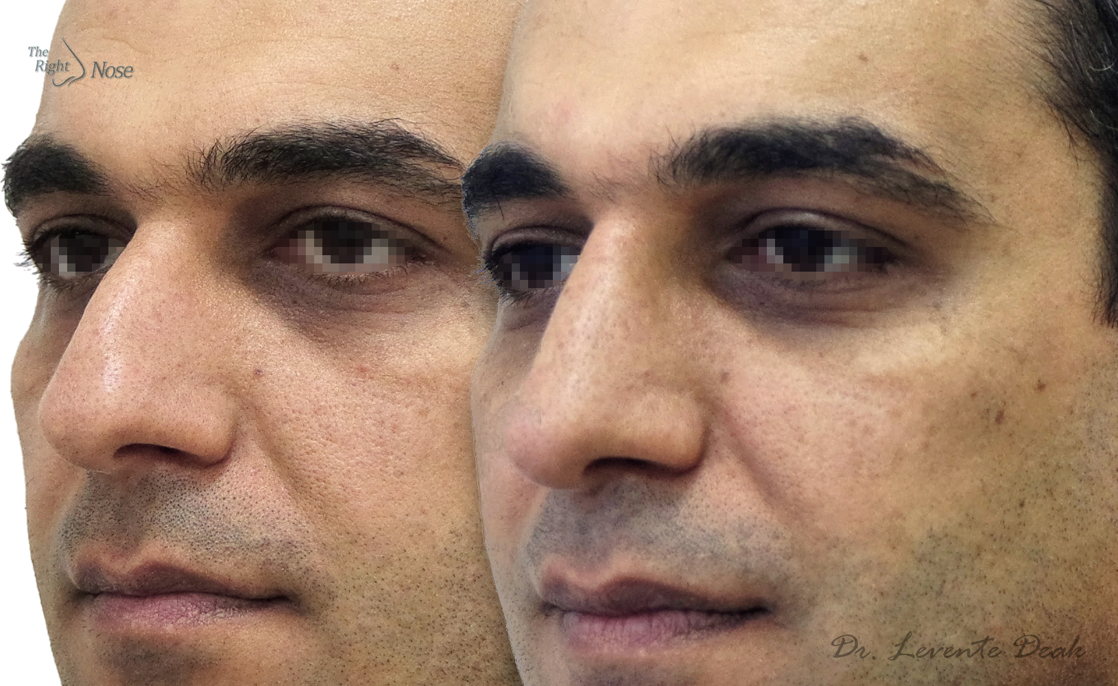 Dorsum and Tip - The right nose