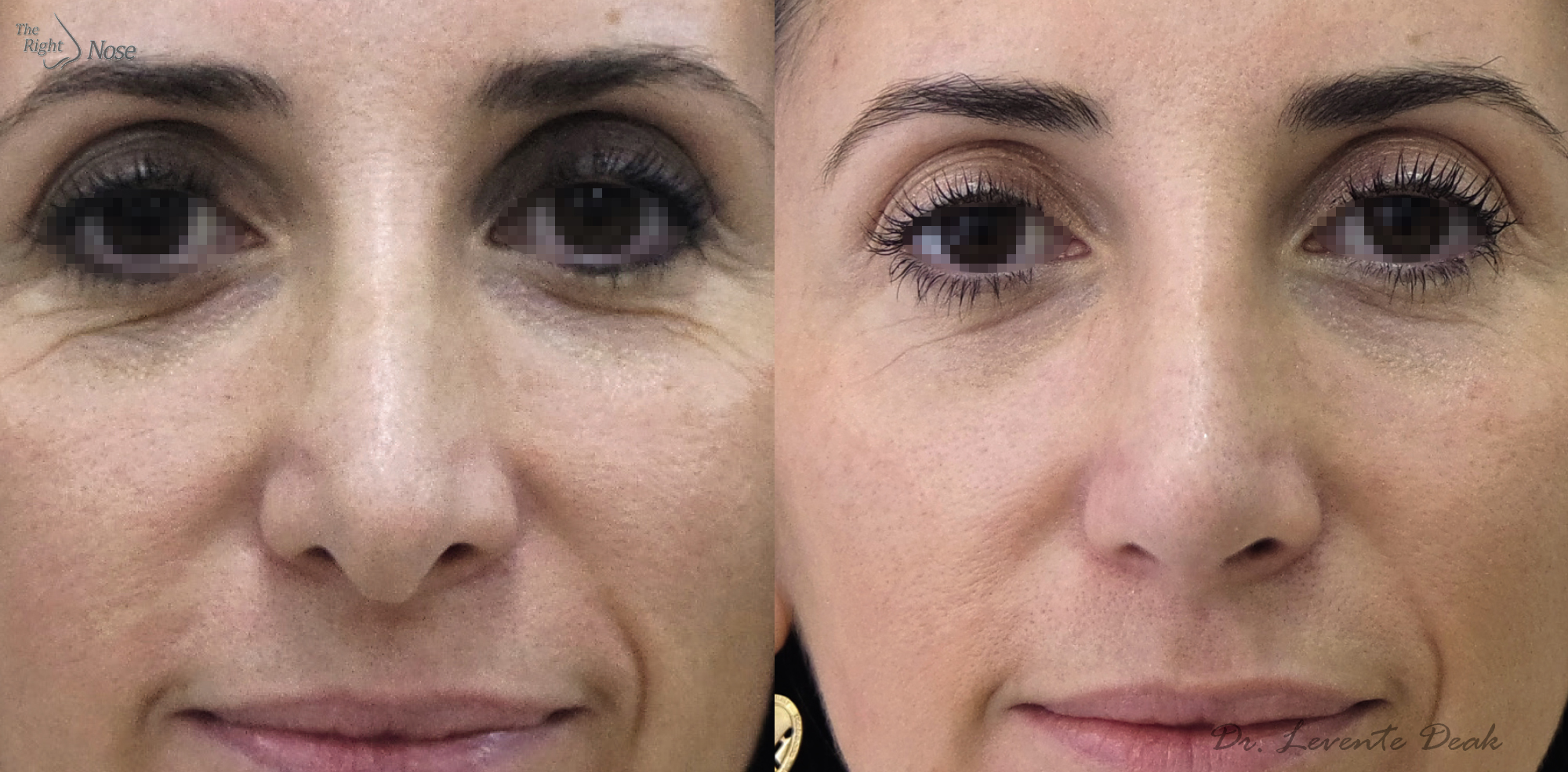Female - Tip correction - The right nose