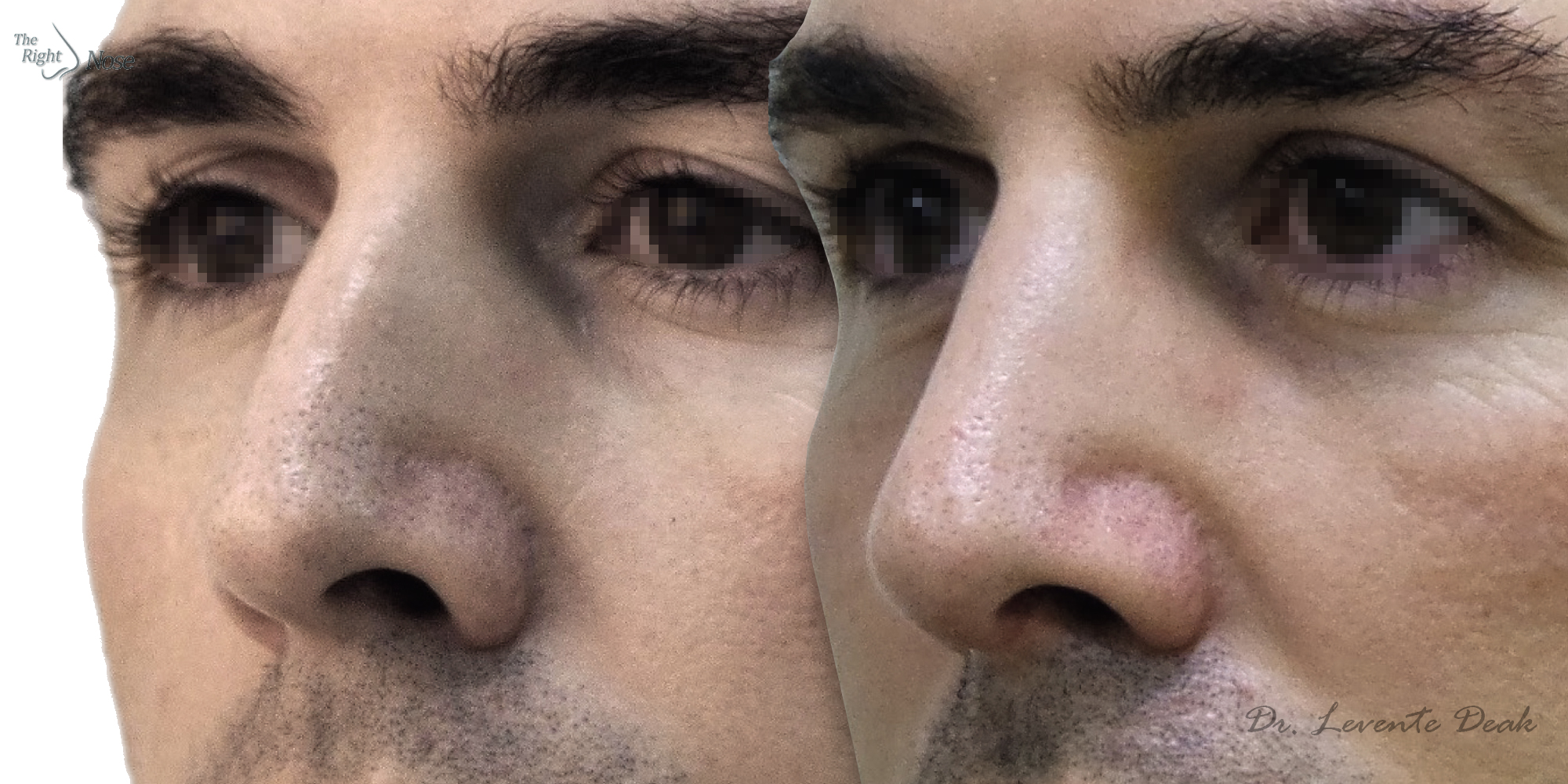 Dorsal Line - The right nose