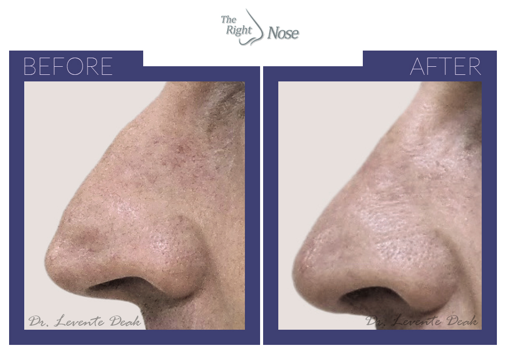 Dorsal Line - The right nose