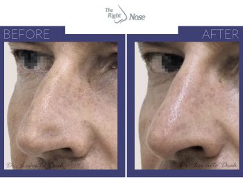 Dorsal Line - The right nose