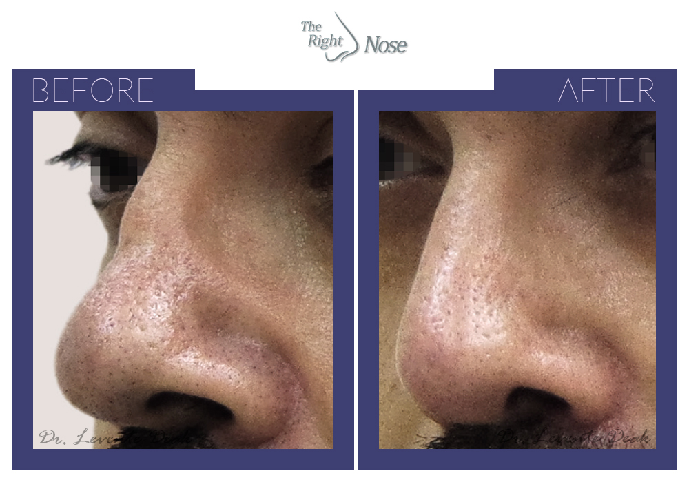 Dorsal Line - The right nose