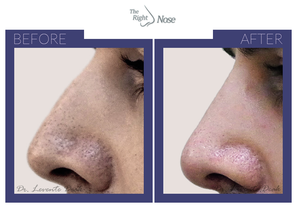 Dorsal Line - The right nose