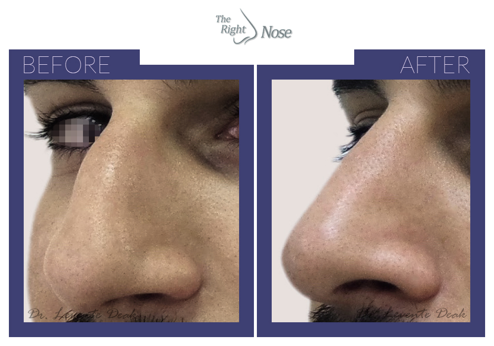 Dorsal Line - The right nose