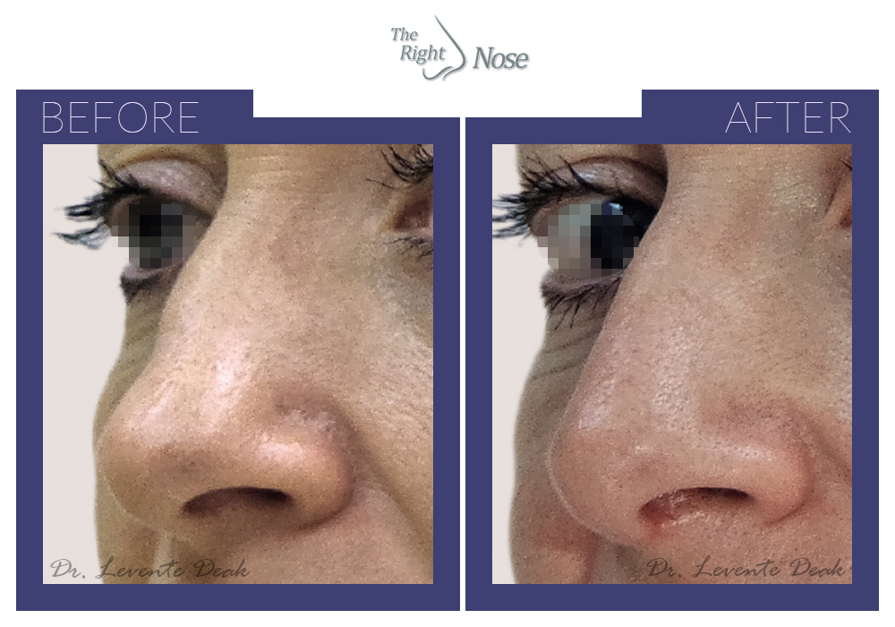 Female - Curving nose - The right nose