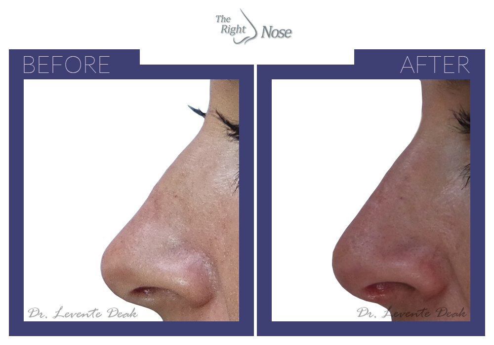 Female - Curving nose - The right nose