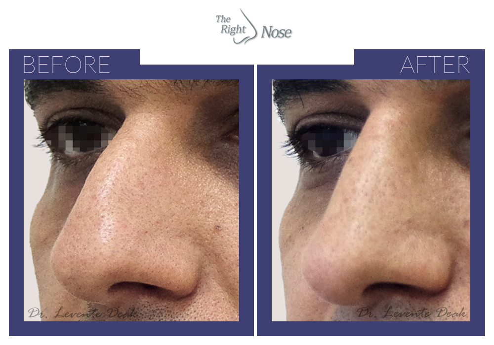 Dorsum and Tip - The right nose