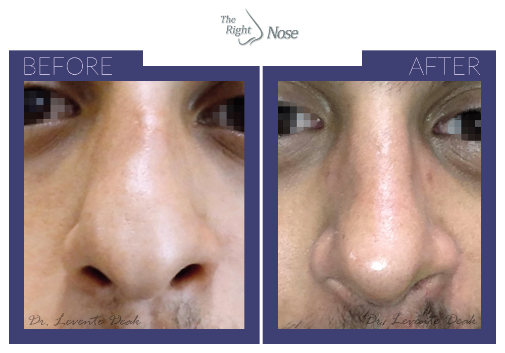 Dorsum and Tip - The right nose