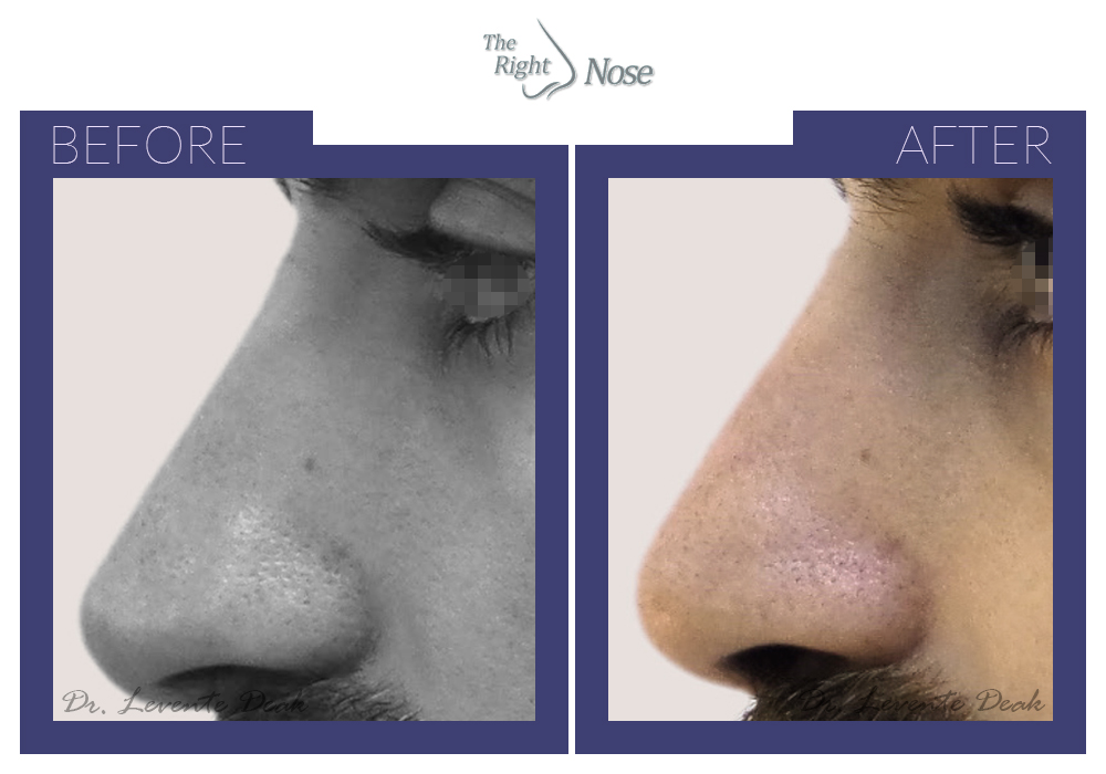 Male Tip - The Right Nose