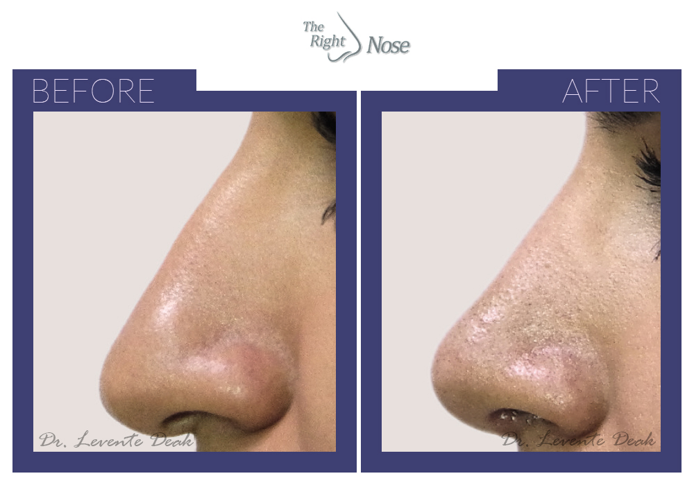 Female - Tip correction - The right nose