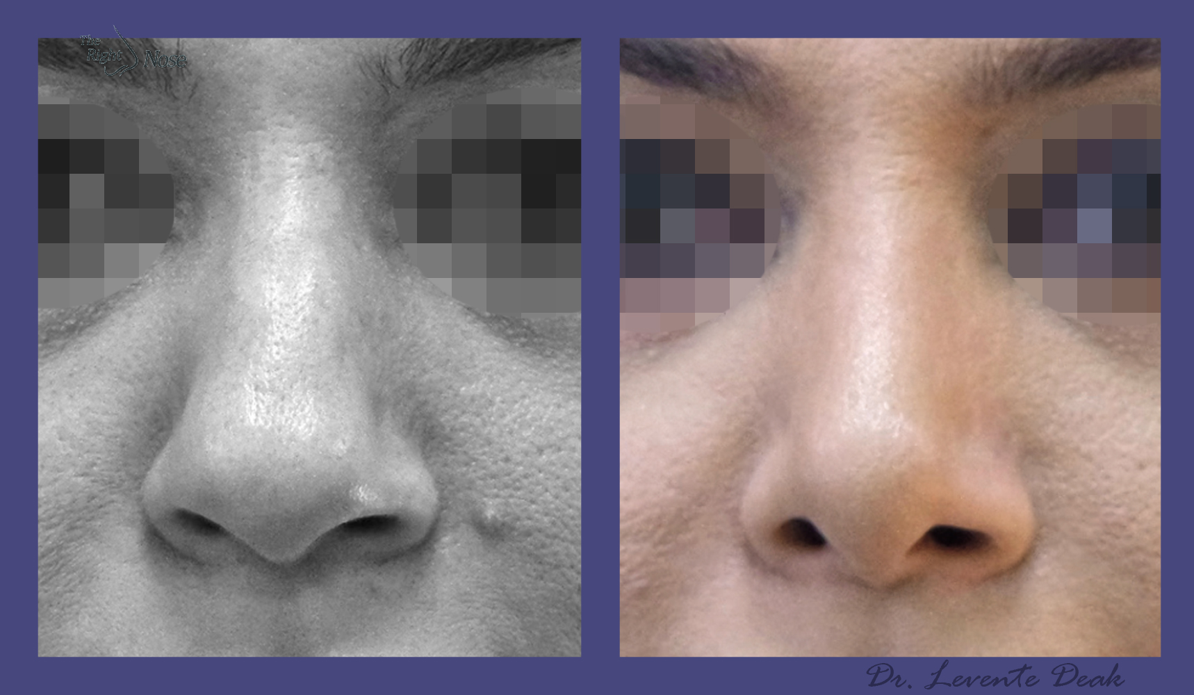 Female - Curving nose - The right nose